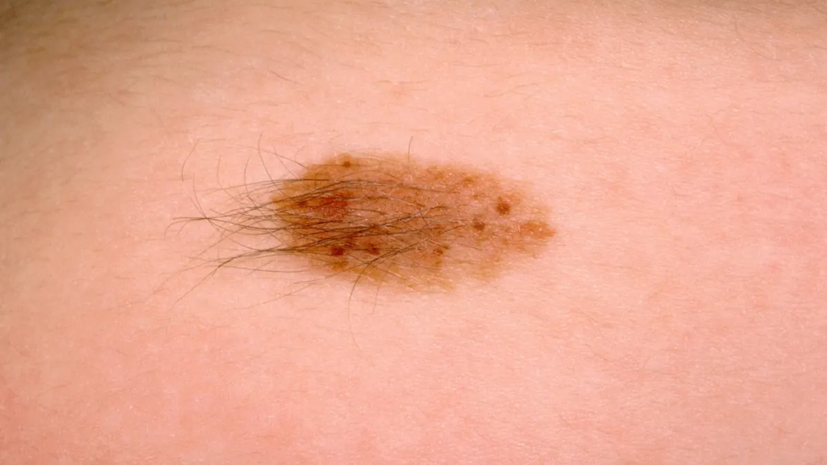 Što znači za organizam ako iz madeža raste dlaka? - Net.hr