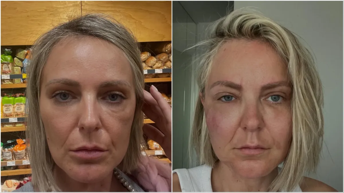 Stankica Stojanović objavila potresne fotografije svog lica - Net.hr